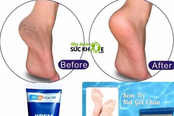 Top 15 kem trị nứt gót chân tốt nhất được bác sĩ khuyên dùng