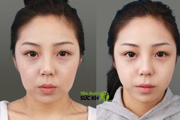 Kem chống nắng Centella Skin1004 SPF50+ PA++++